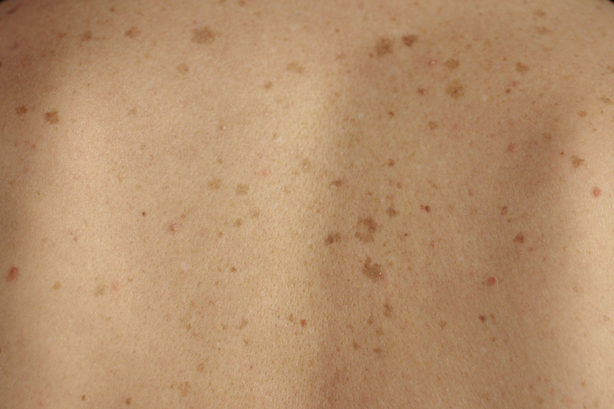 Revue générale : infections nécrosantes de la peau et des parties molles