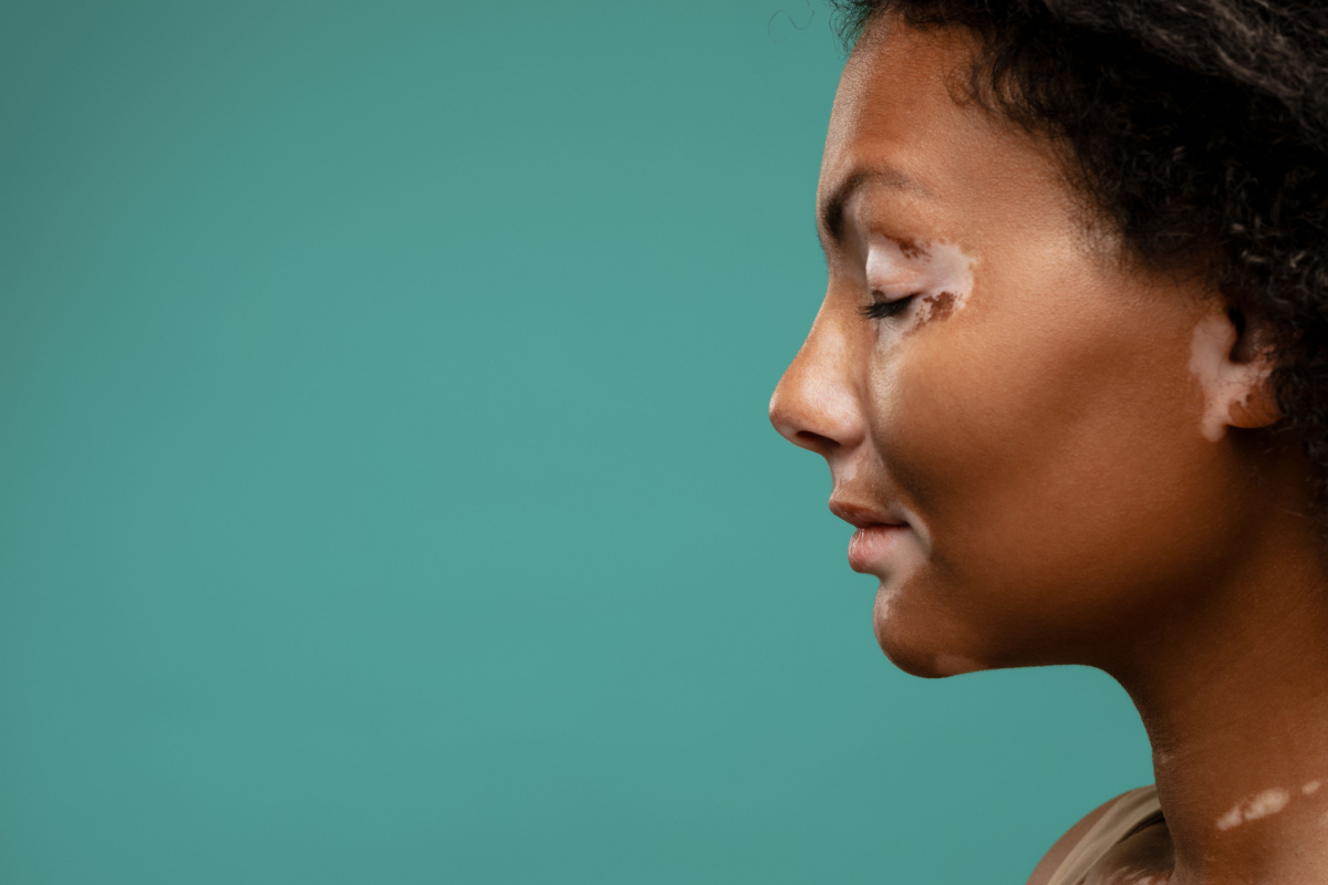 ComPaRe Vitiligo : les patients perçoivent une aggravation d’autant ...